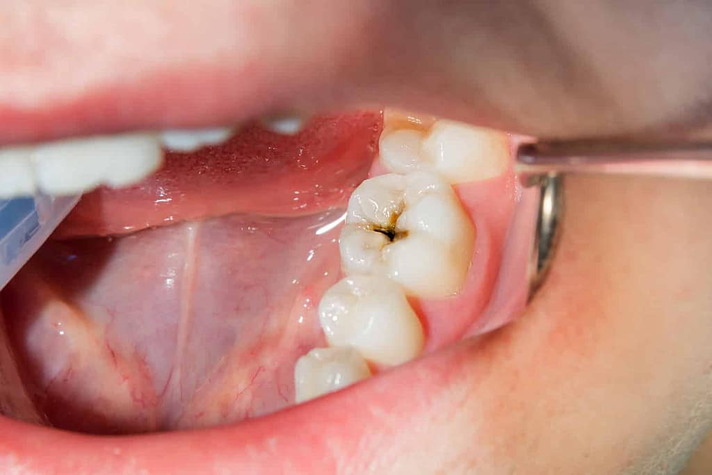 How To Cover A Cavity On Front Tooth (2024 Update)