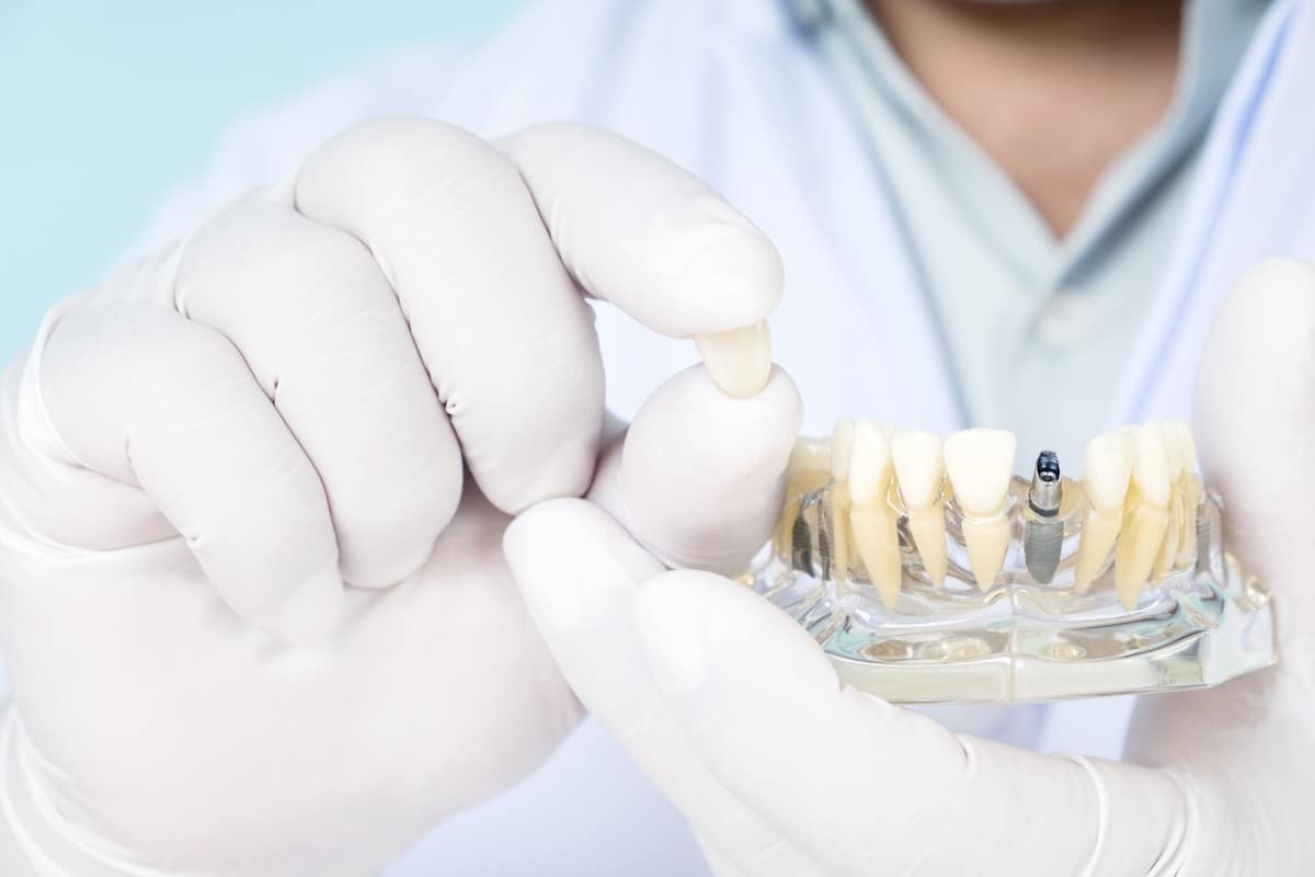 Best Options For Missing Tooth Replacement (2025)