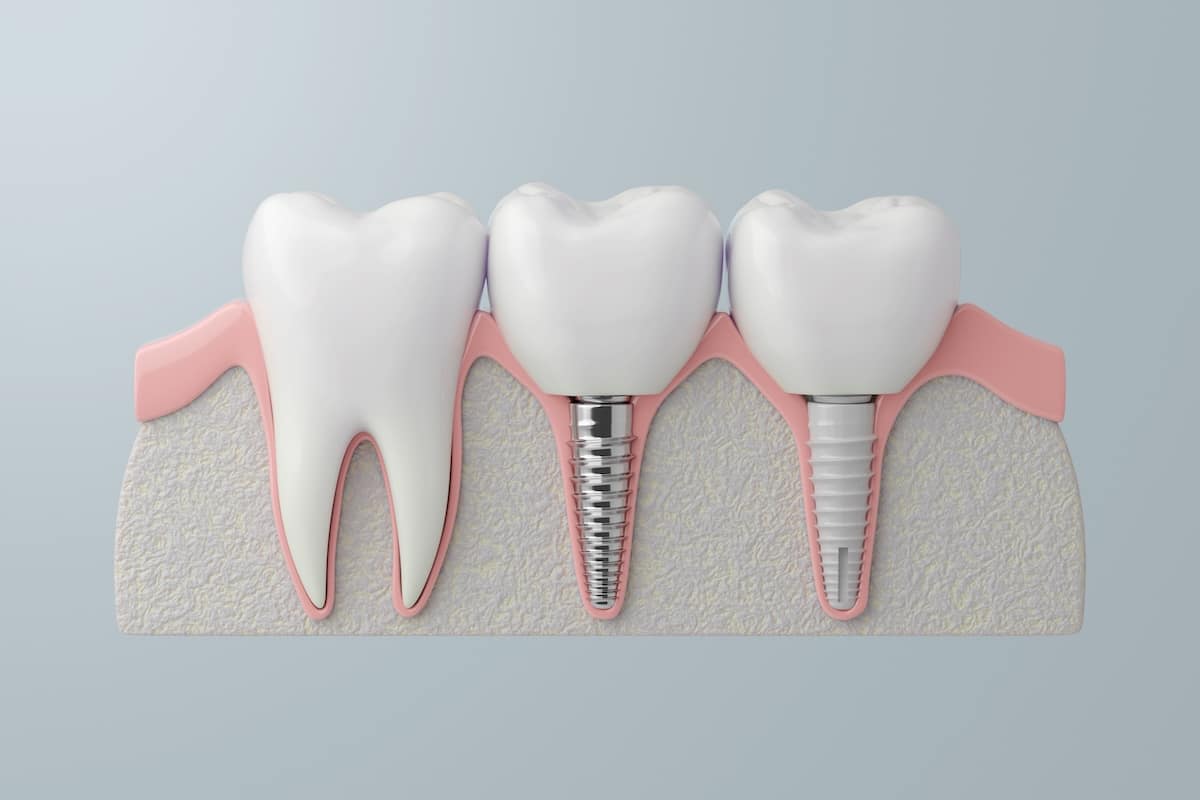 7 Benefits Of Ceramic Dental Implants