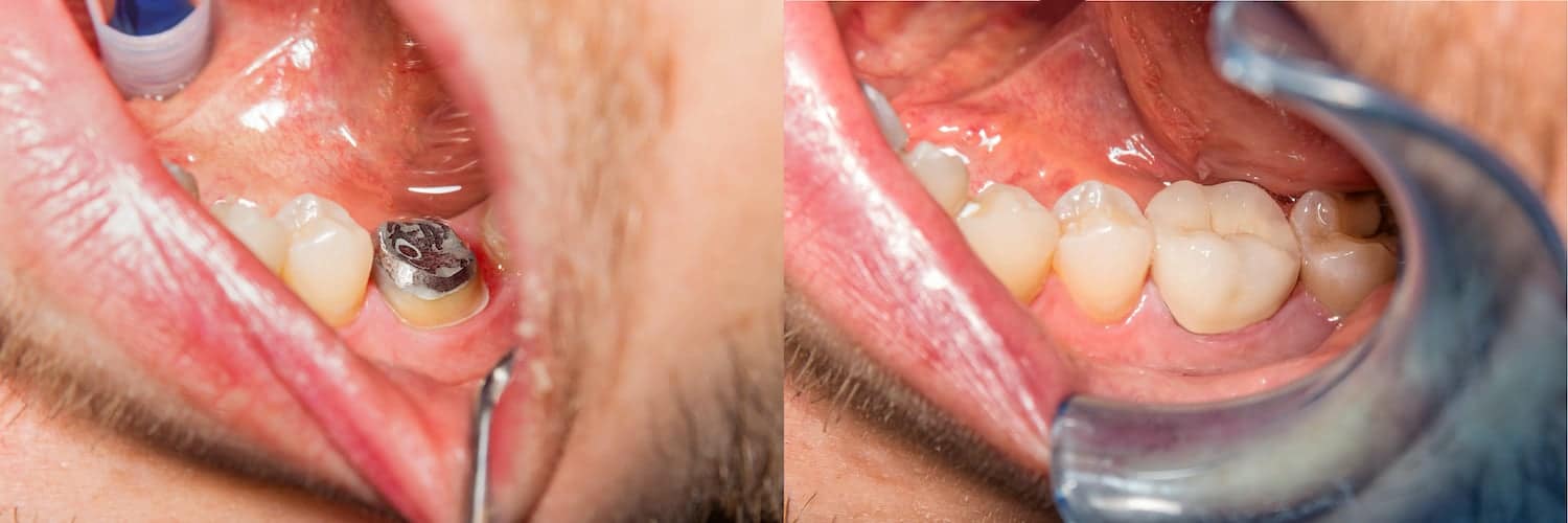 4 Most-Common Teeth Whitening Side Effects