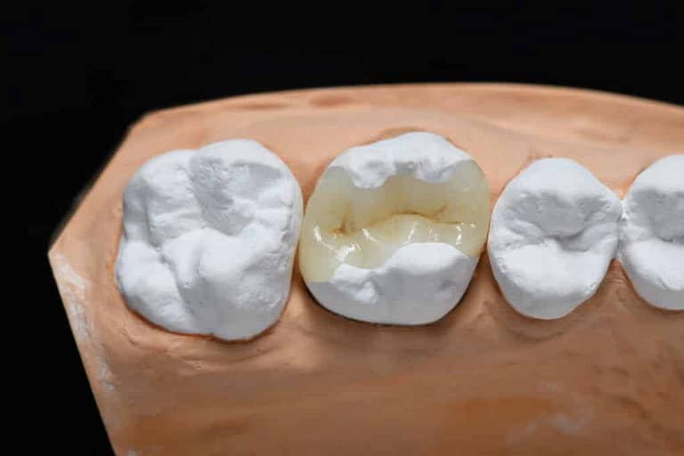 Dental Inlays Vs. Onlays: Do You Need Them? (Pros & Cons)